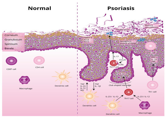 Neurological Complications of Biological Treatment of Psoriasis