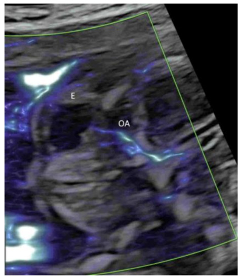 Life Free Full Text Update On Color Flow Imaging In Obstetrics