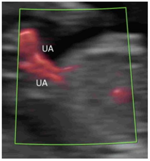 Update on Color Flow Imaging in Obstetrics