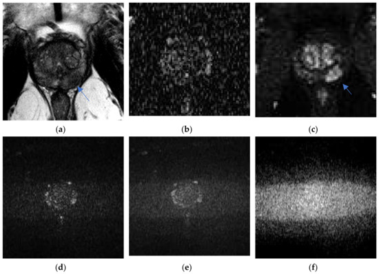 Life | Free Full-Text | Prostate MRI: Is Endorectal Coil Necessary?—A ...