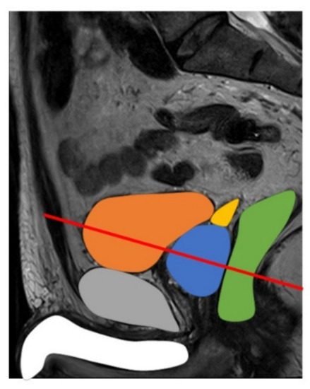 Prostate MRI: Is Endorectal Coil Necessary?—A Review