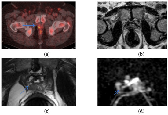 Life | Free Full-Text | Prostate MRI: Is Endorectal Coil Necessary?—A ...