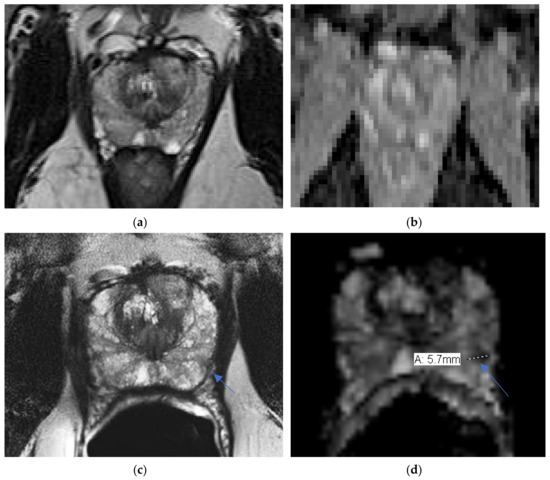 Life | Free Full-Text | Prostate MRI: Is Endorectal Coil Necessary?—A ...