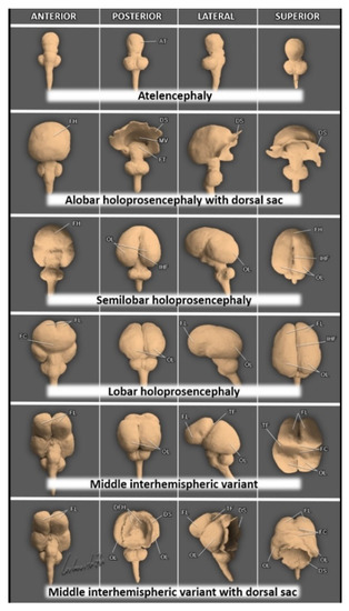 Fetal Brain Development: Regulating Processes and Related Malformations