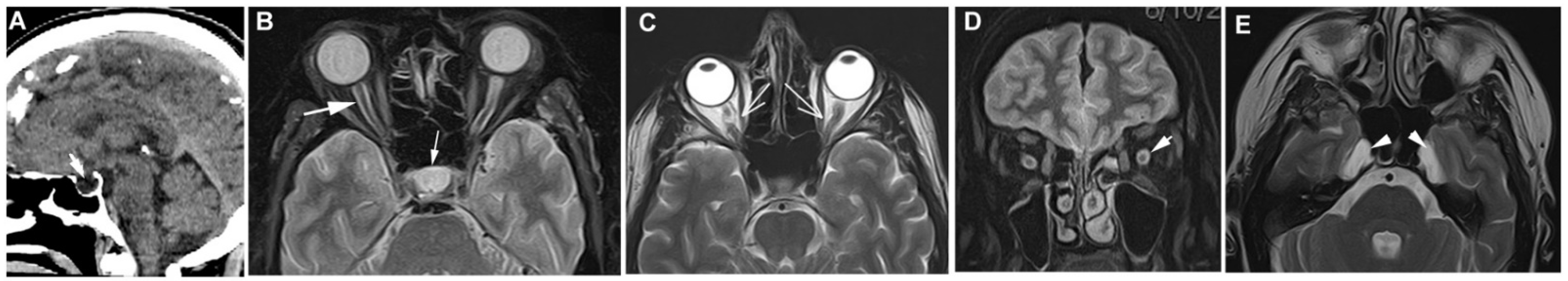 Cerebral Venous Outflow Implications in Idiopathic Intracranial ...