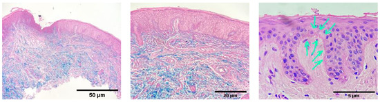 Anti-MDA5 Amyopathic Dermatomyositis—A Diagnostic and Therapeutic Challenge