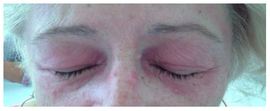 Anti-MDA5 Amyopathic Dermatomyositis—A Diagnostic and Therapeutic Challenge