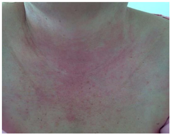 Anti-MDA5 Amyopathic Dermatomyositis—A Diagnostic and Therapeutic Challenge
