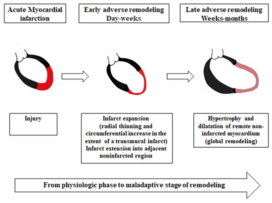Life Free Full Text Left Ventricular Remodeling After Myocardial