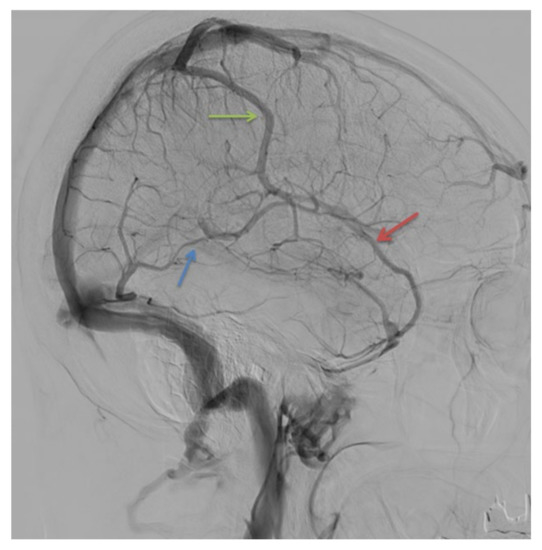 Imaging of Cerebral Venous Thrombosis