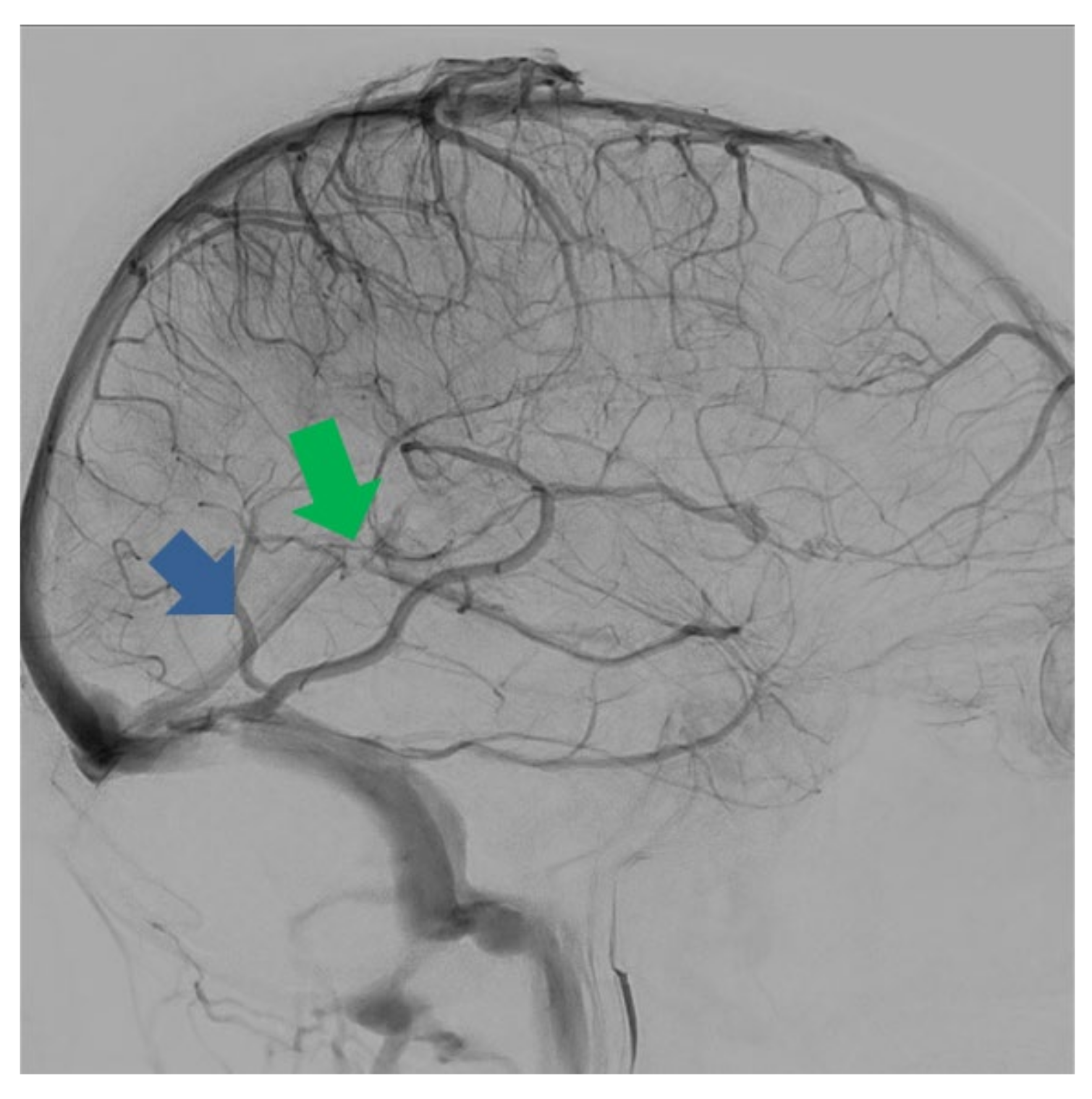 Imaging of Cerebral Venous Thrombosis