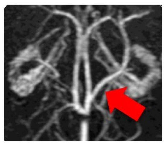 Imaging of Cerebral Venous Thrombosis