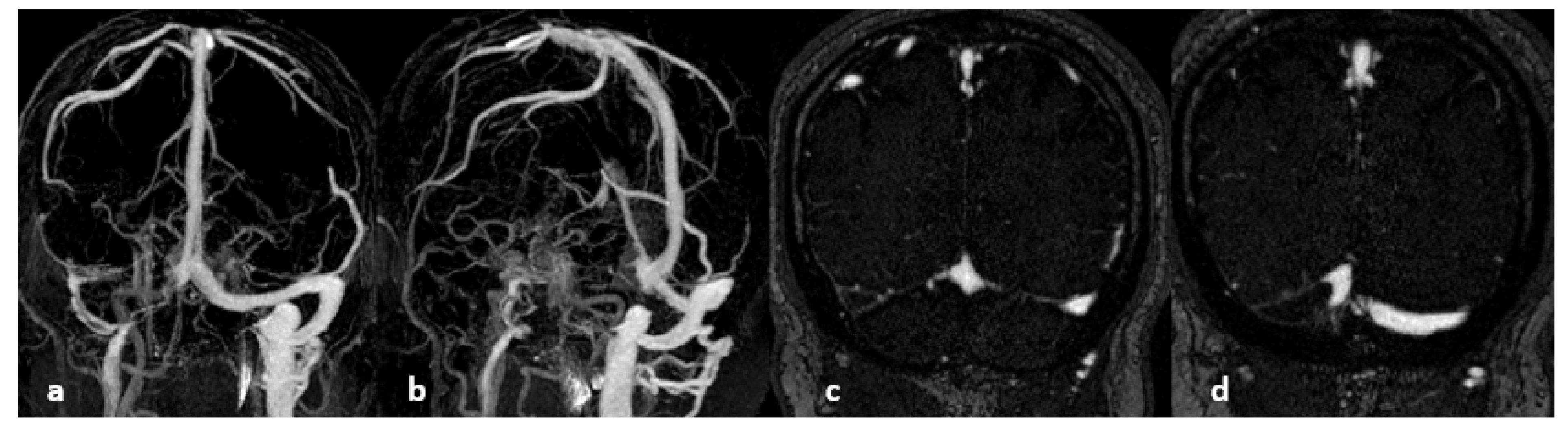 Imaging of Cerebral Venous Thrombosis