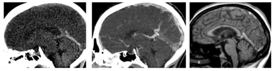 Imaging of Cerebral Venous Thrombosis