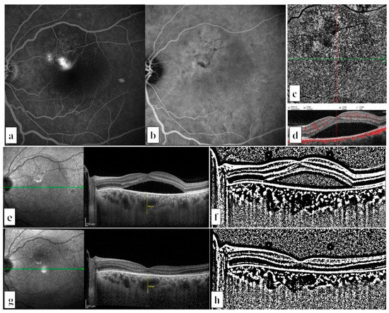 A Comparative Study of Short-Term Vascular and Stromal Alterations of ...
