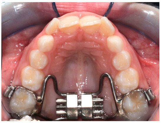 Evaluation of the Upper Arch Morphological Changes after Two Different ...