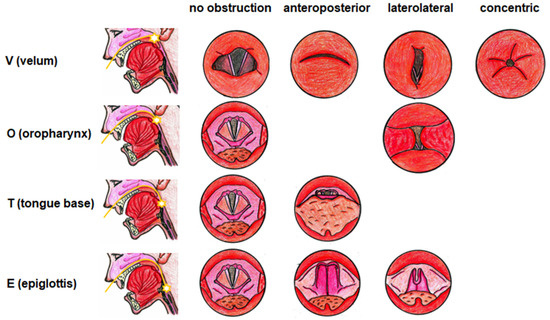 Epiglottopexy Is a Treatment of Choice for Obstructive Sleep Apnea ...