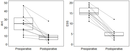 Epiglottopexy Is a Treatment of Choice for Obstructive Sleep Apnea ...
