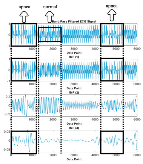 Life | Free Full-Text | A Deep Learning Framework for Automatic Sleep Apnea Classification Based ...
