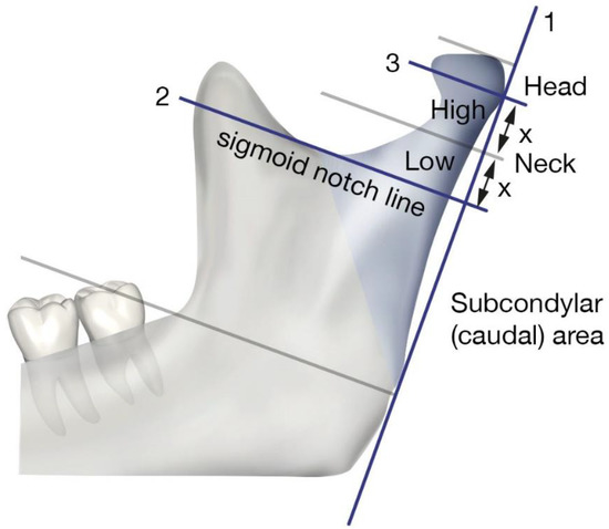 Functional Orthodontic Treatment of Mandibular Condyle Fractures in ...