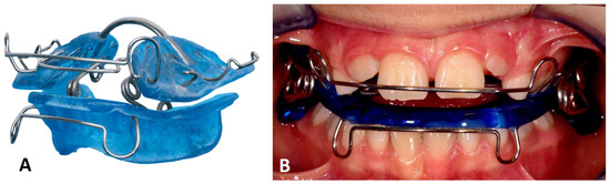 Functional Orthodontic Treatment of Mandibular Condyle Fractures in ...