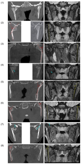 Functional Orthodontic Treatment of Mandibular Condyle Fractures in ...