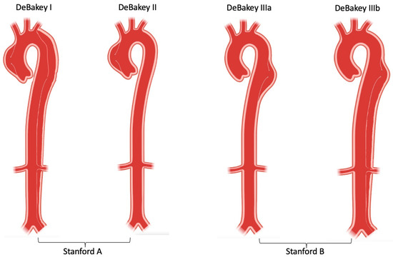 Current Understanding of Aortic Dissection