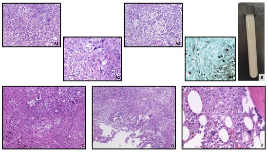 Diffuse Adrenal Gland and Pancreas Necrosis in a Patient with ...