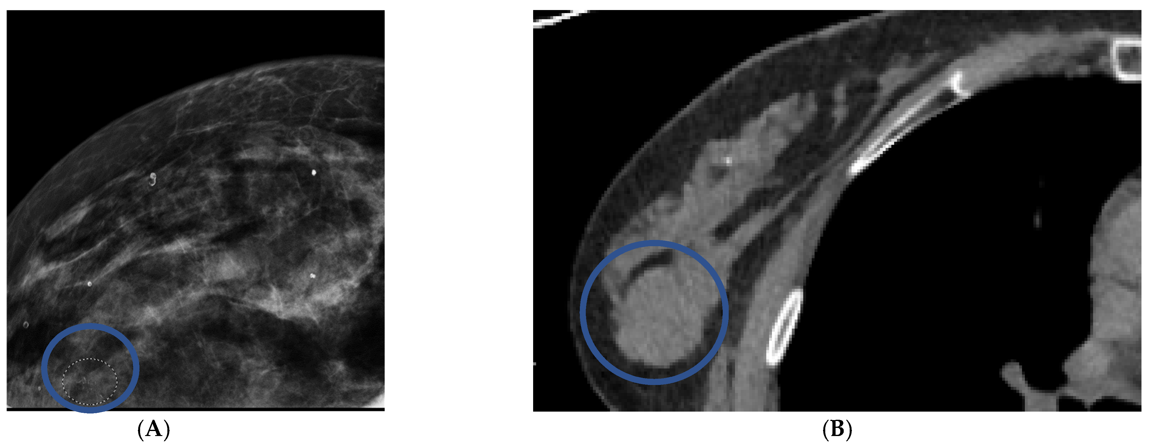 Chest CT for Breast Cancer Diagnosis