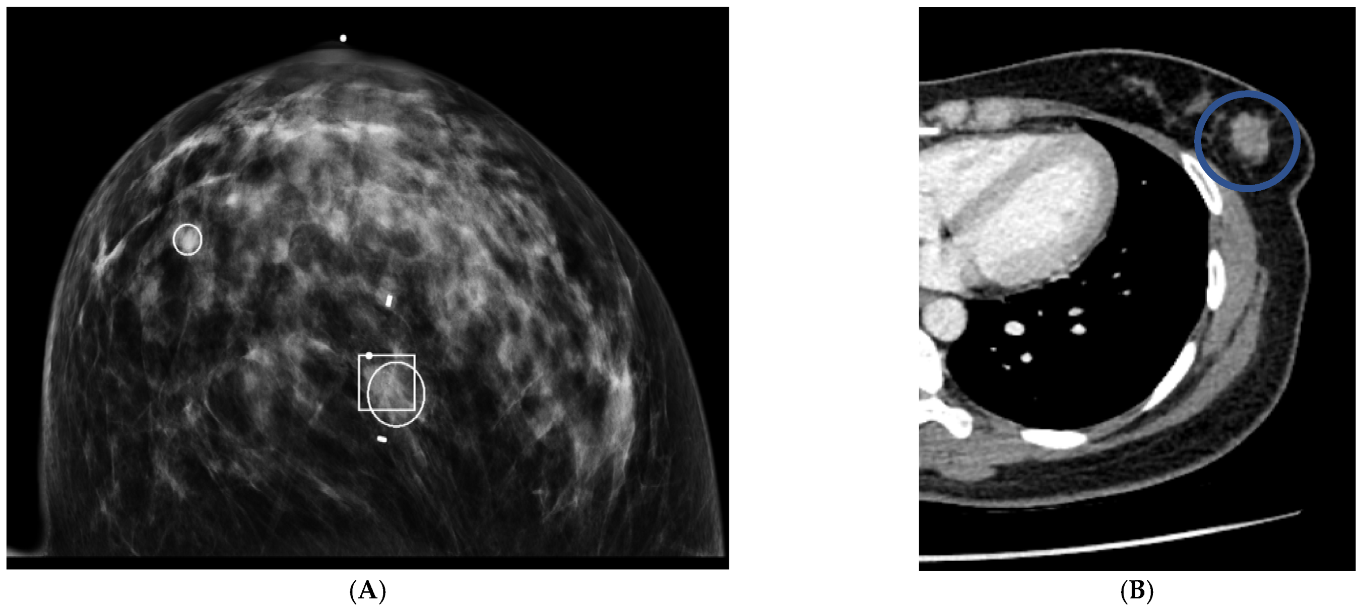 Chest CT for Breast Cancer Diagnosis