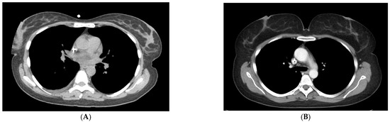 Chest CT for Breast Cancer Diagnosis