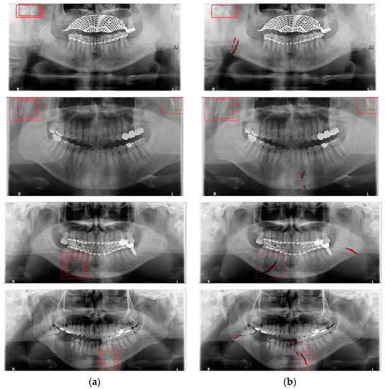 Combined Deep Learning Techniques for Mandibular Fracture Diagnosis ...