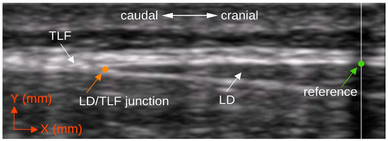 Associations between Deformation of the Thoracolumbar Fascia and ...