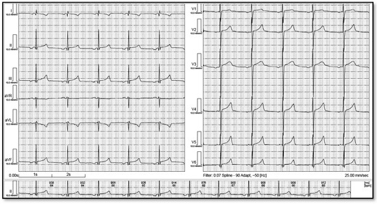 Low Atrial Rhythm in a Large Cohort of Children from Transylvania, Romania