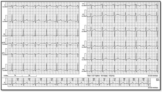 Low Atrial Rhythm in a Large Cohort of Children from Transylvania, Romania