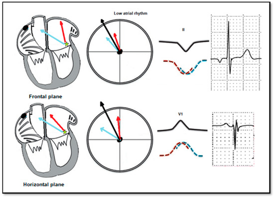 Low Atrial Rhythm in a Large Cohort of Children from Transylvania, Romania