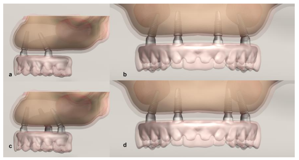 Biomechanical Comparison of Asymmetric Implant Configurations for All ...