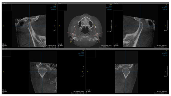 Evaluation of Cortical Bone Formation on Mandibular Condyle in ...