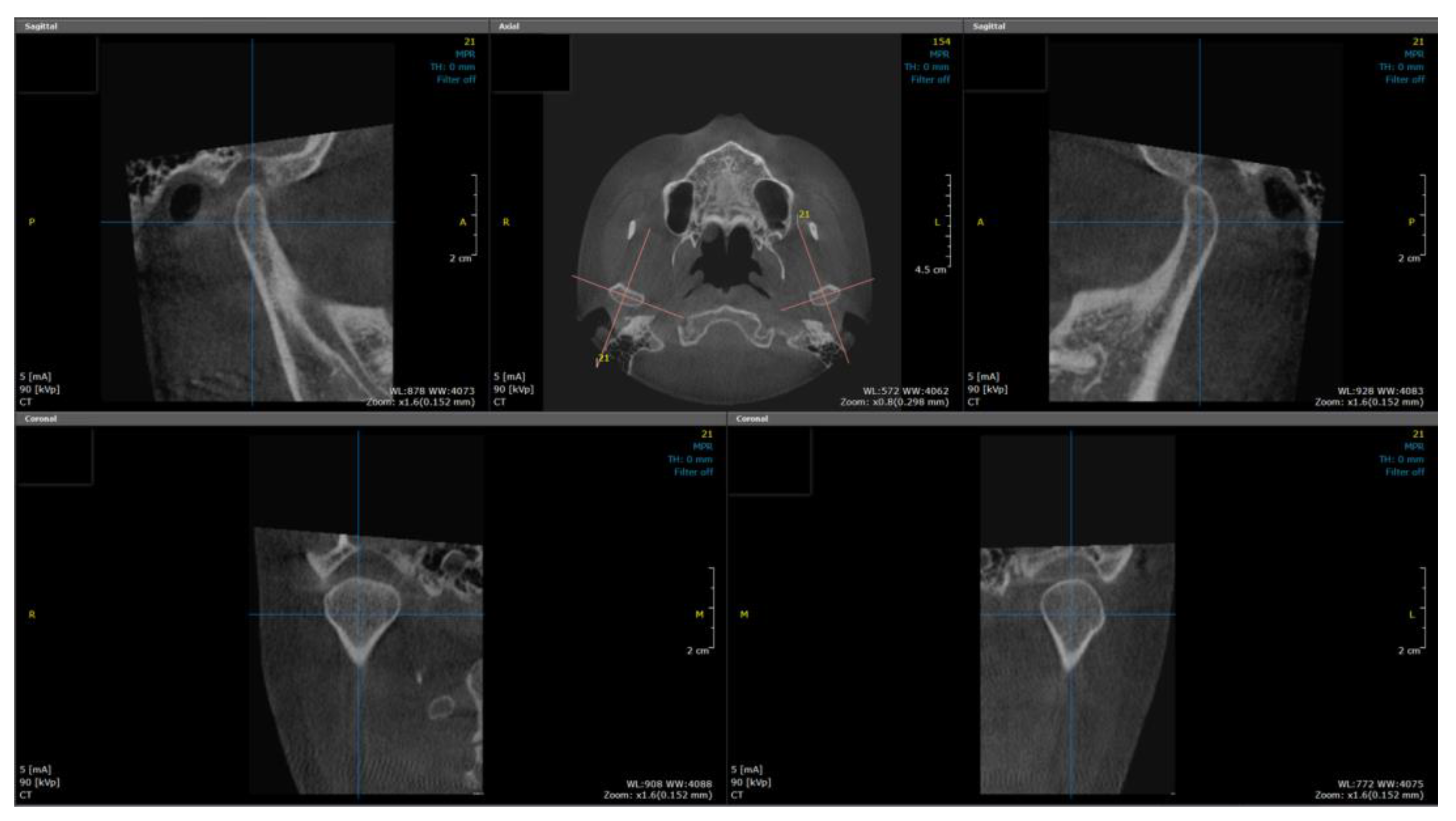 Evaluation of Cortical Bone Formation on Mandibular Condyle in ...