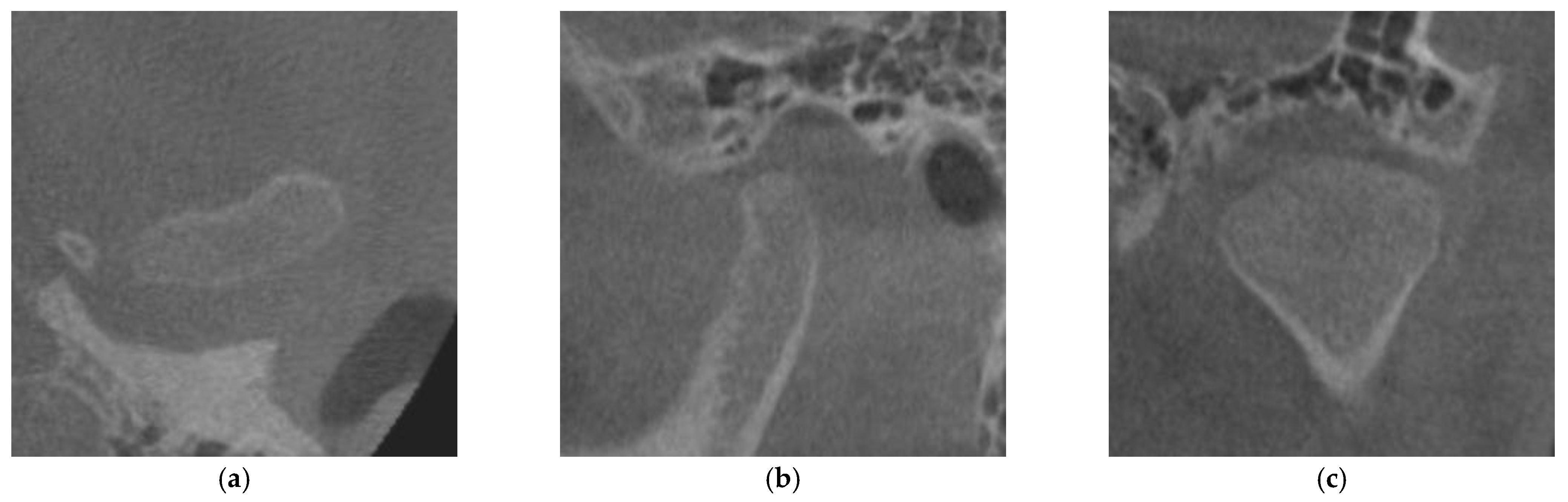 Evaluation of Cortical Bone Formation on Mandibular Condyle in ...