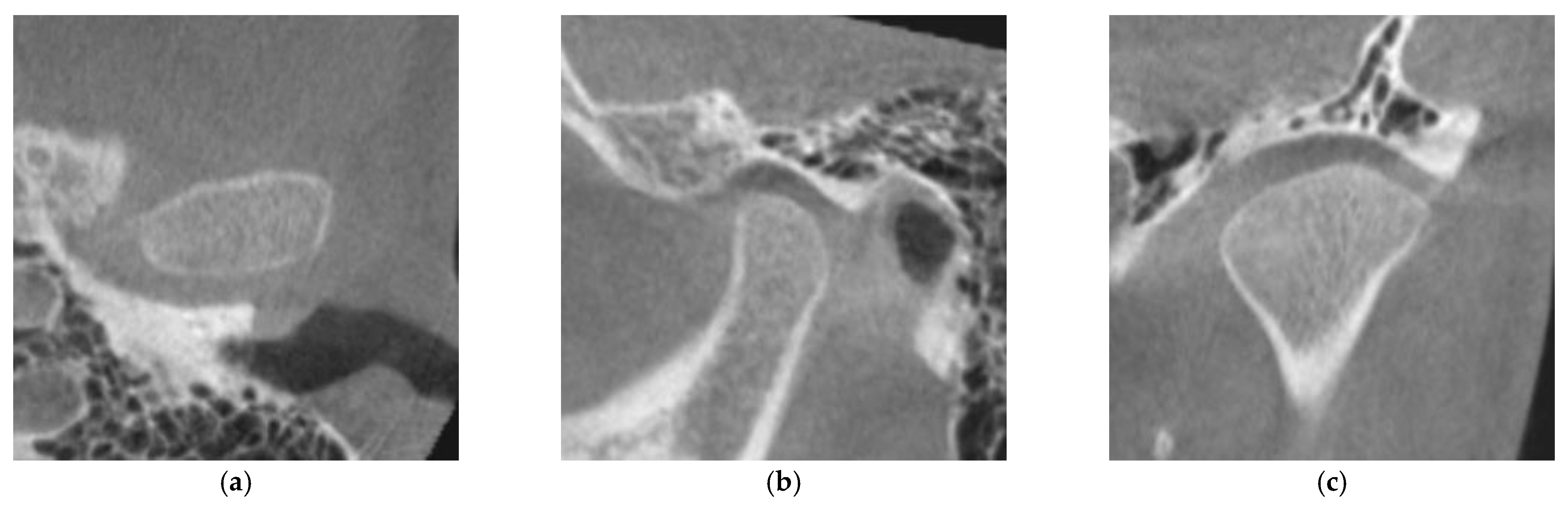 Evaluation of Cortical Bone Formation on Mandibular Condyle in ...