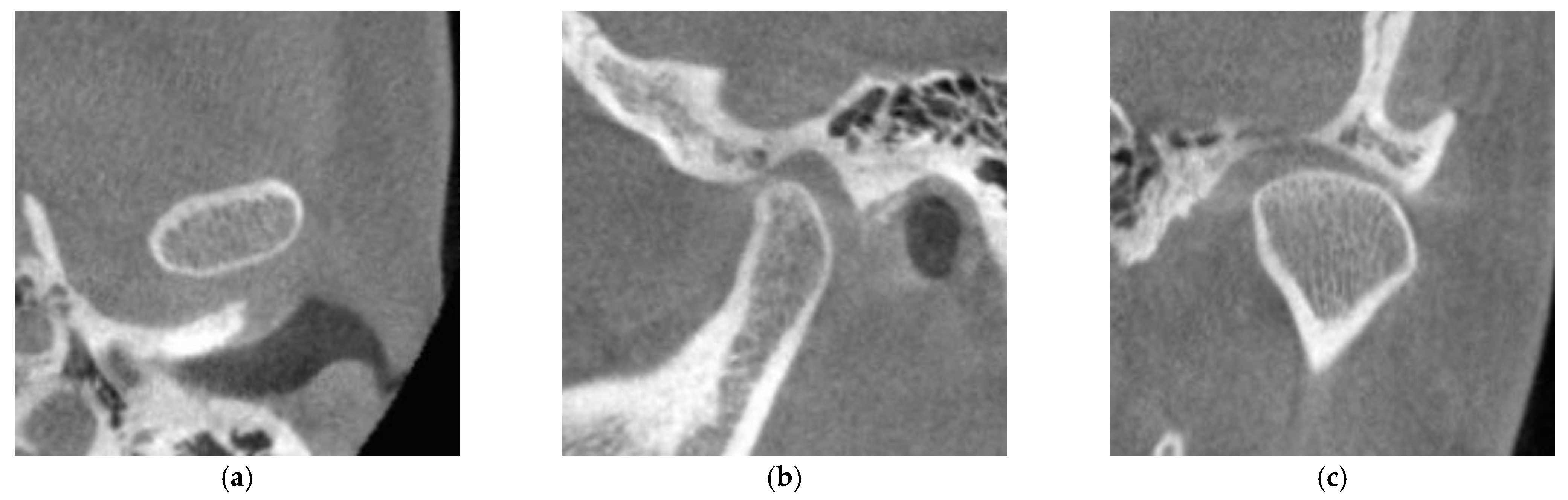 Evaluation of Cortical Bone Formation on Mandibular Condyle in ...