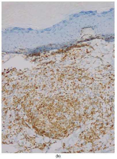 Primary Cutaneous B-Cell Lymphoma Co-Existing with Mycosis Fungoides—A Case Report and Overview ...