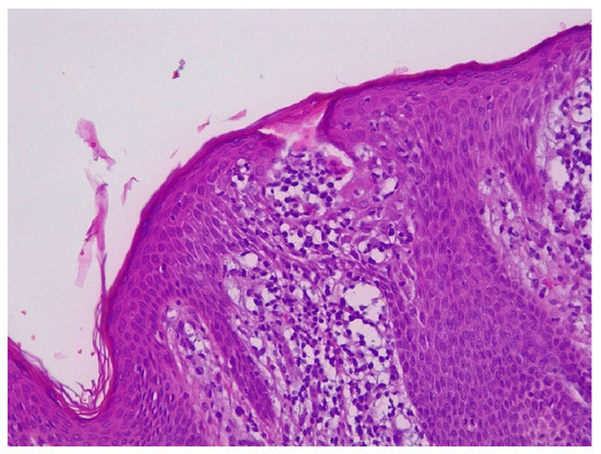 Primary Cutaneous B-Cell Lymphoma Co-Existing with Mycosis Fungoides—A Case Report and Overview ...