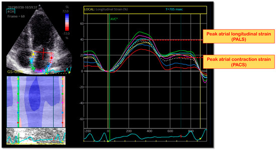 Left Atrial Remodeling in Response to Aortic Valve Replacement ...