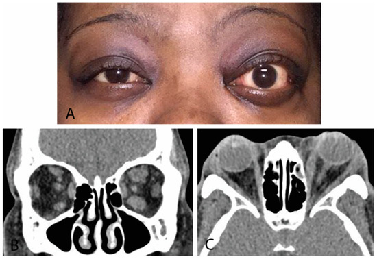 Thyroid Eye Disease