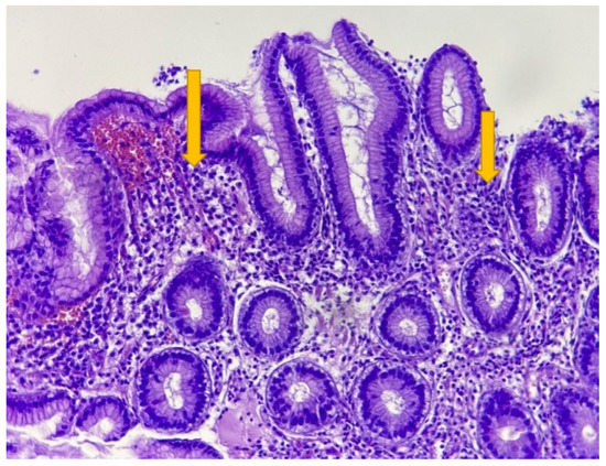 Correlations between Endoscopic and Histopathological Assessment of ...