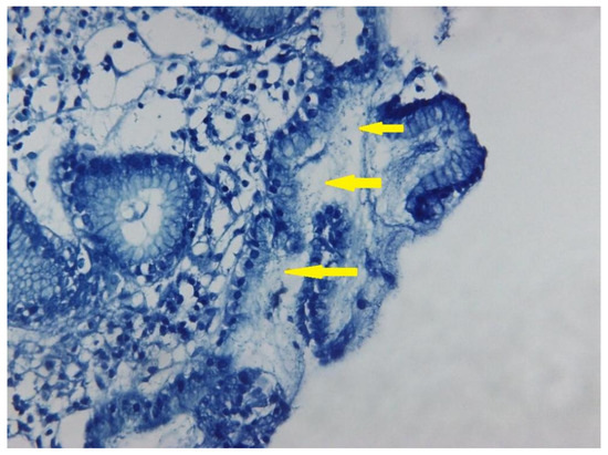 Correlations between Endoscopic and Histopathological Assessment of ...