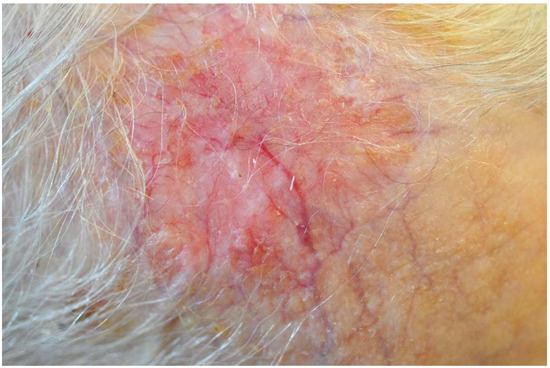 Erosive Pustular Dermatosis: Delving into Etiopathogenesis and Management
