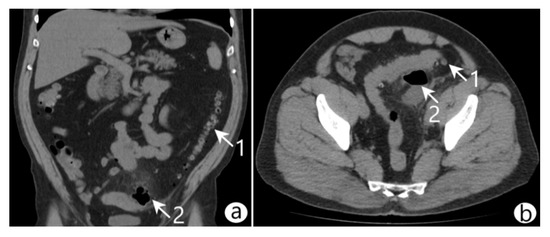 Microbiota of the Colonic Diverticula in the Complicated Form of ...